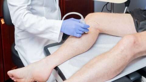 What is Radiofrequency Ablation (RFA) for Varicose veins?