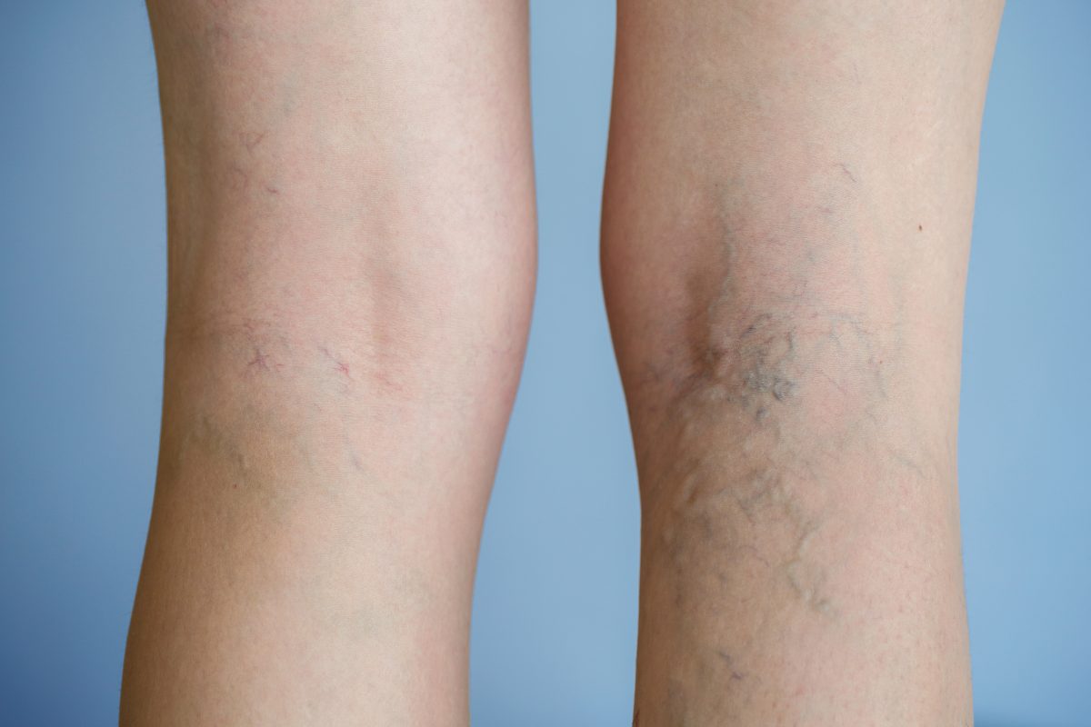 Harvard Trained Vein Doctor | Do you Have Spider Veins? | Learn More ...
