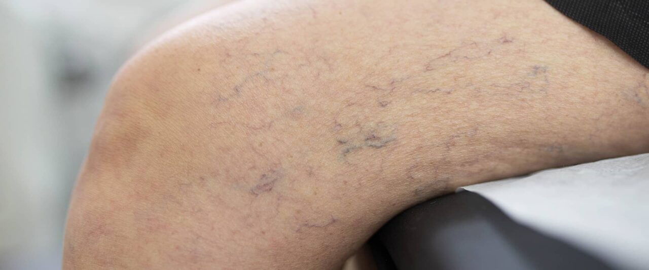 Ambulatory Phlebectomy for Varicose Veins | Vein Experts