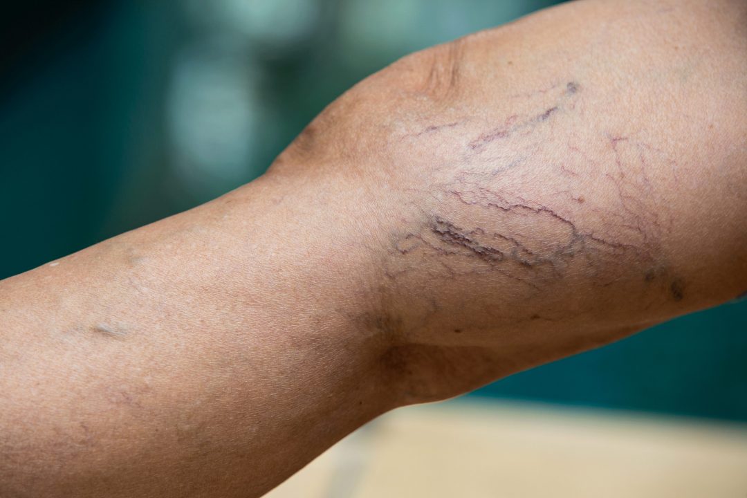 Harvard Trained Vein Doctors | Laser Vein Removal Centers | Spider and ...