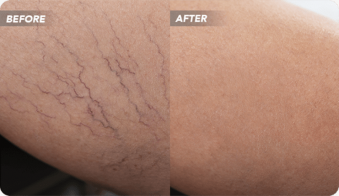 Sclerotherapy Treatment for Spider & Varicose Veins