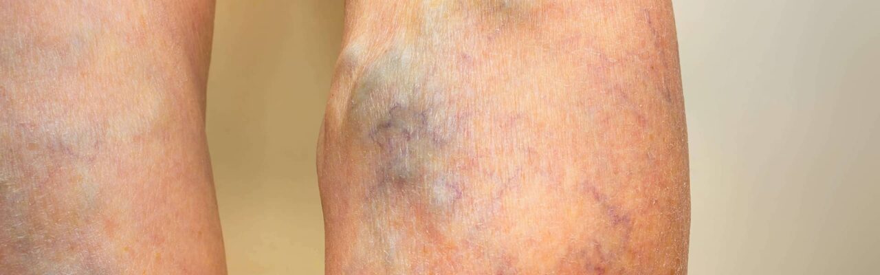 Harvard Trained Vein Doctor | Can Varicose Veins Cause Pain? Common ...