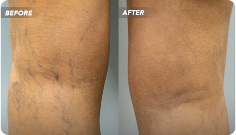 Vein Clinic New York | Vein Treatment New York | #1 Vein Center