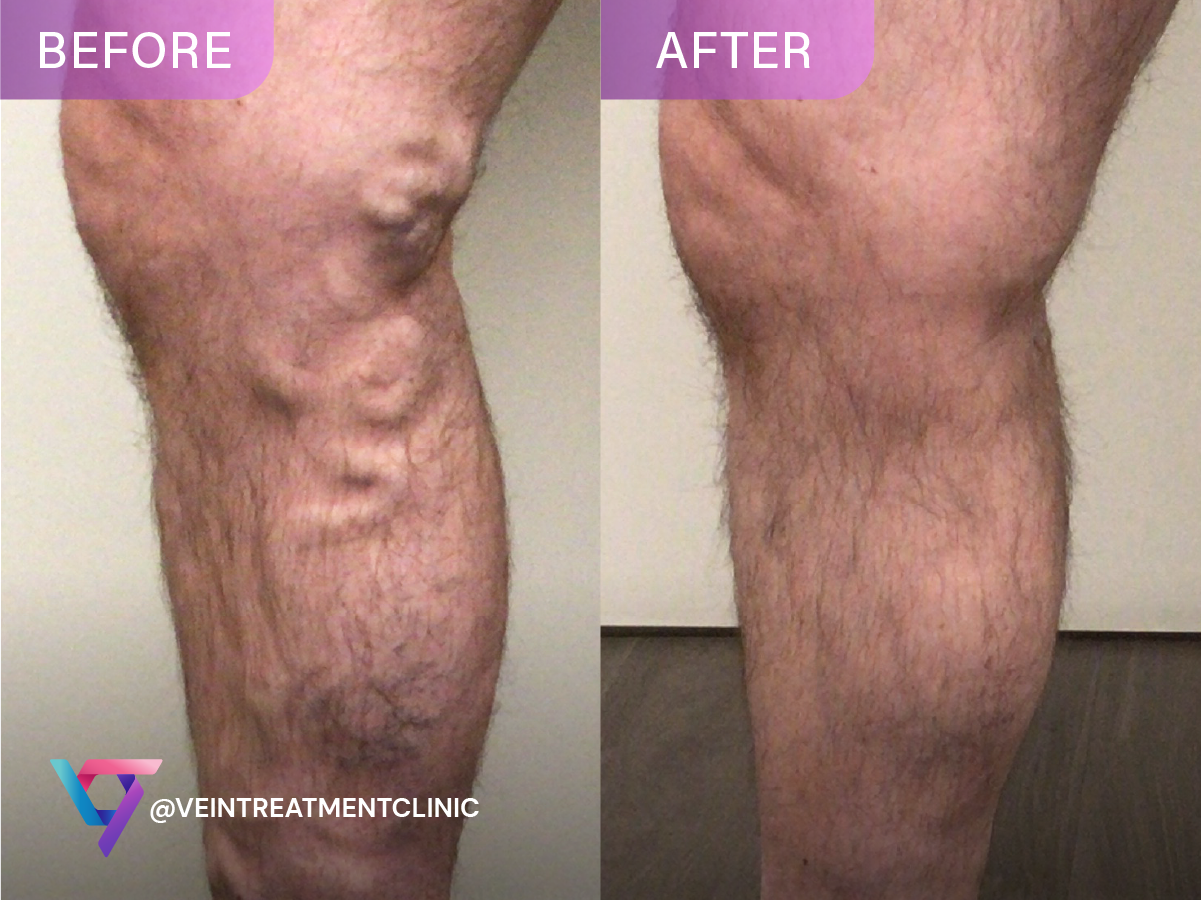 Book Appointment - Ivy League -Trained Vein Doctors | Vein Treatment Center - Spider and ...