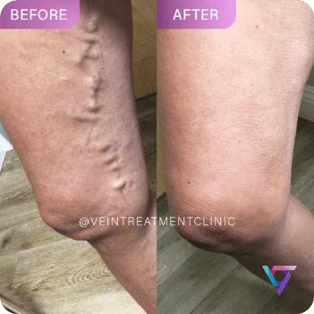 Book Appointment Online - Ivy League -Trained Vein Doctors | Vein Treatment Center - Spider and ...