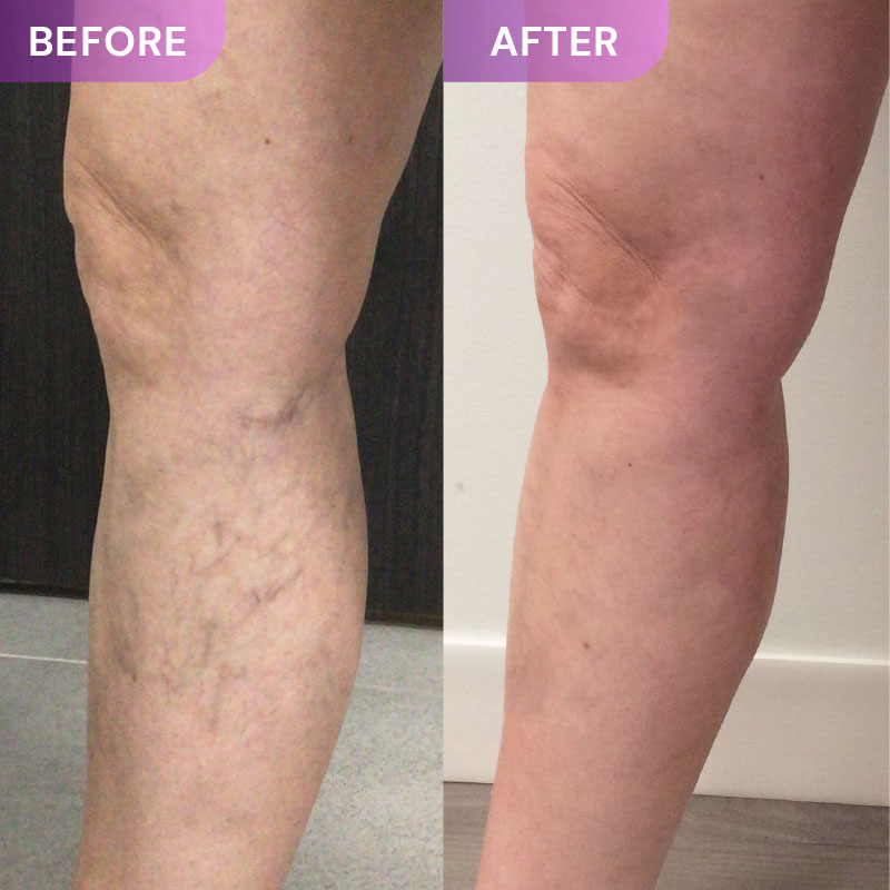 Exercise for Vein Health: Benefits & Tips