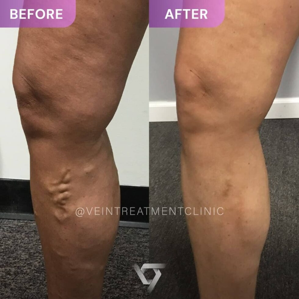 Vein Treatment in Fort Worth, TX | Varicose & Spider Veins