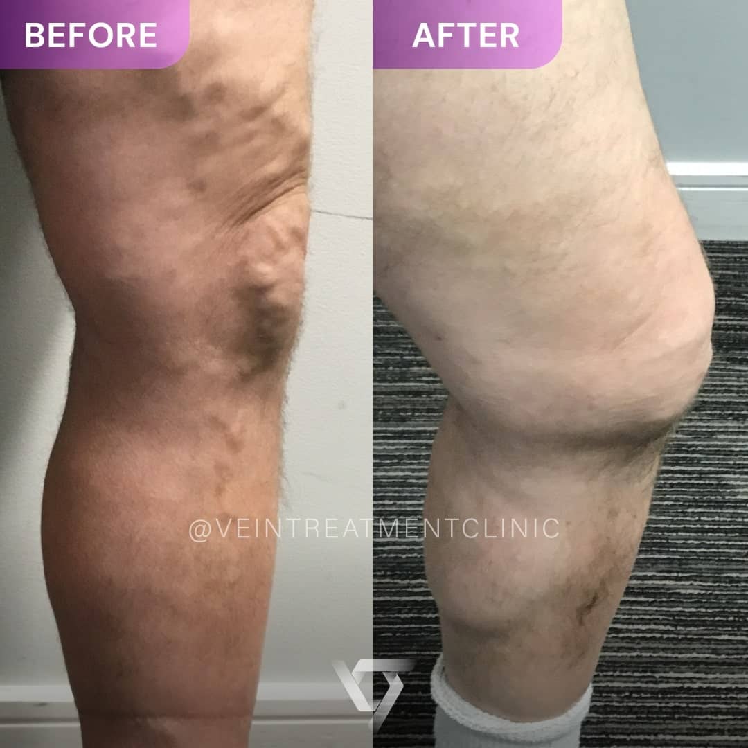 Radiofrequency Ablation (RFA) for Varicose Vein Treatment