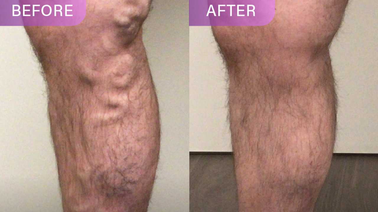 Vein Treatment Clinic in the Bronx, New York, NY