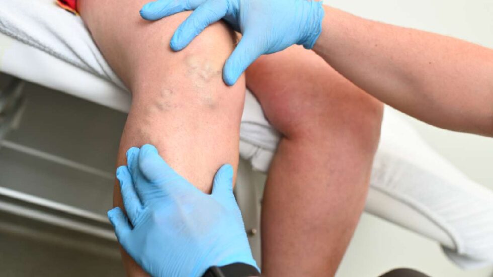 What Is Vein Stripping? Minimally Invasive Alternatives
