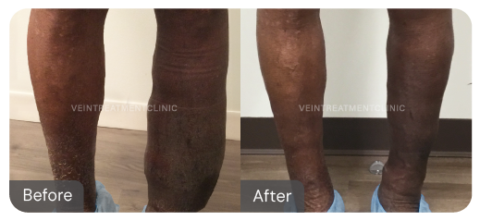 Leg Swelling: Causes, Symptoms & When Veins Are the Problem | Vein ...