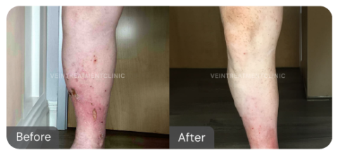 Venous Ulcers (Varicose Ulcers): Causes, Healing & Treatment | Vein ...